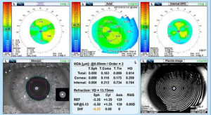 OPD Scan III | Cataracts Framingham | Putnoi Eye Care